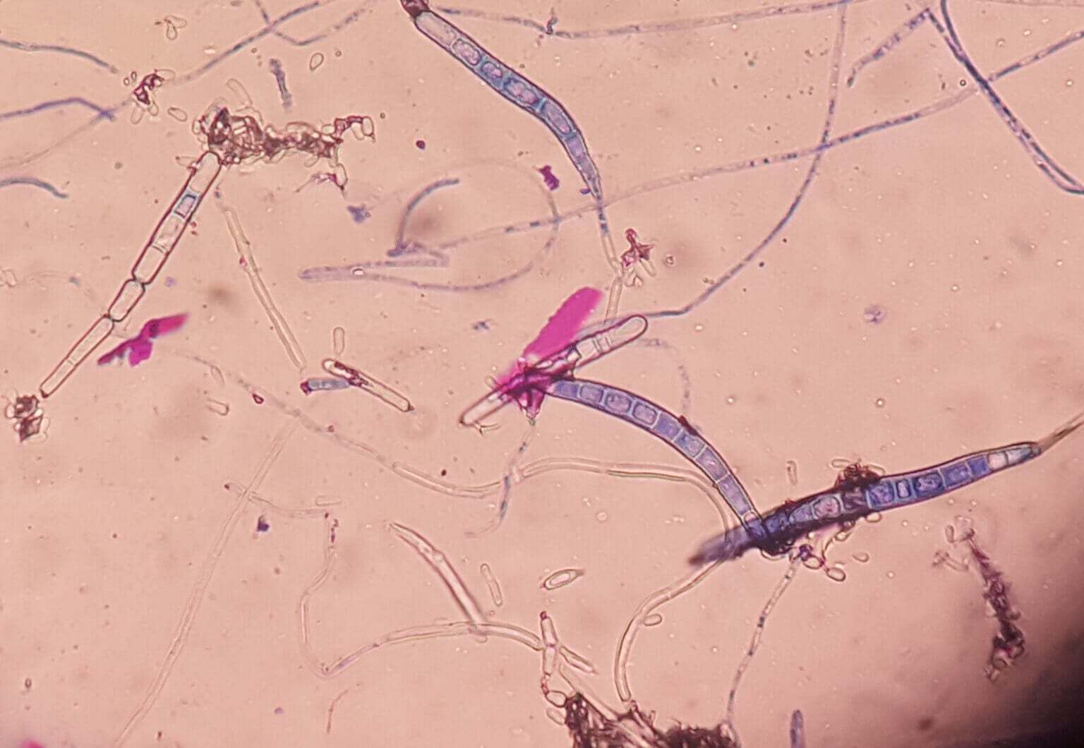 Trichophyton mentagrophytes Resistance & Antifungal Treatments