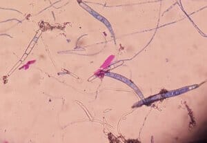 Trichophyton mentagrophytes Resistance & Antifungal Treatments